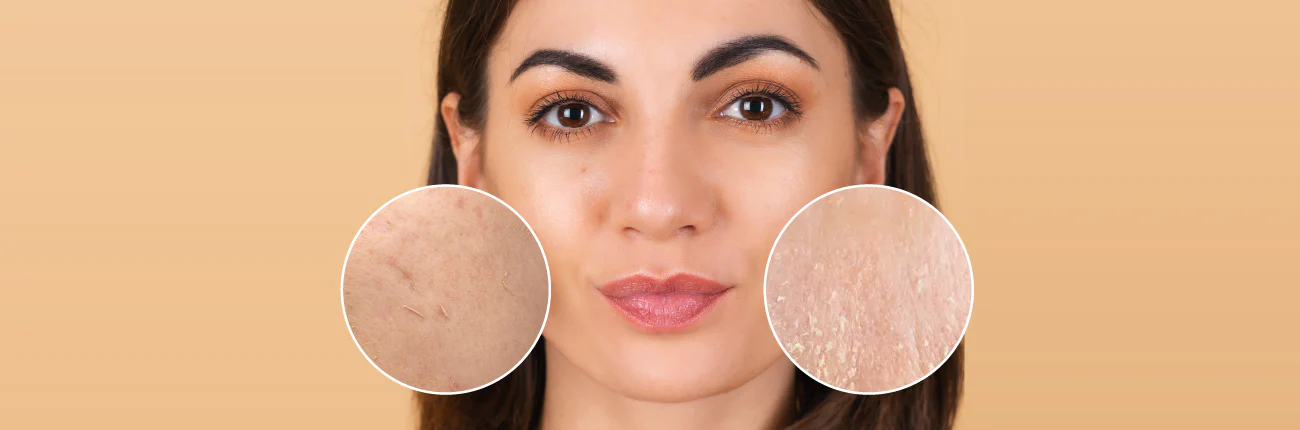 Peeling skin on your face? These best skin peeling products can be your ...