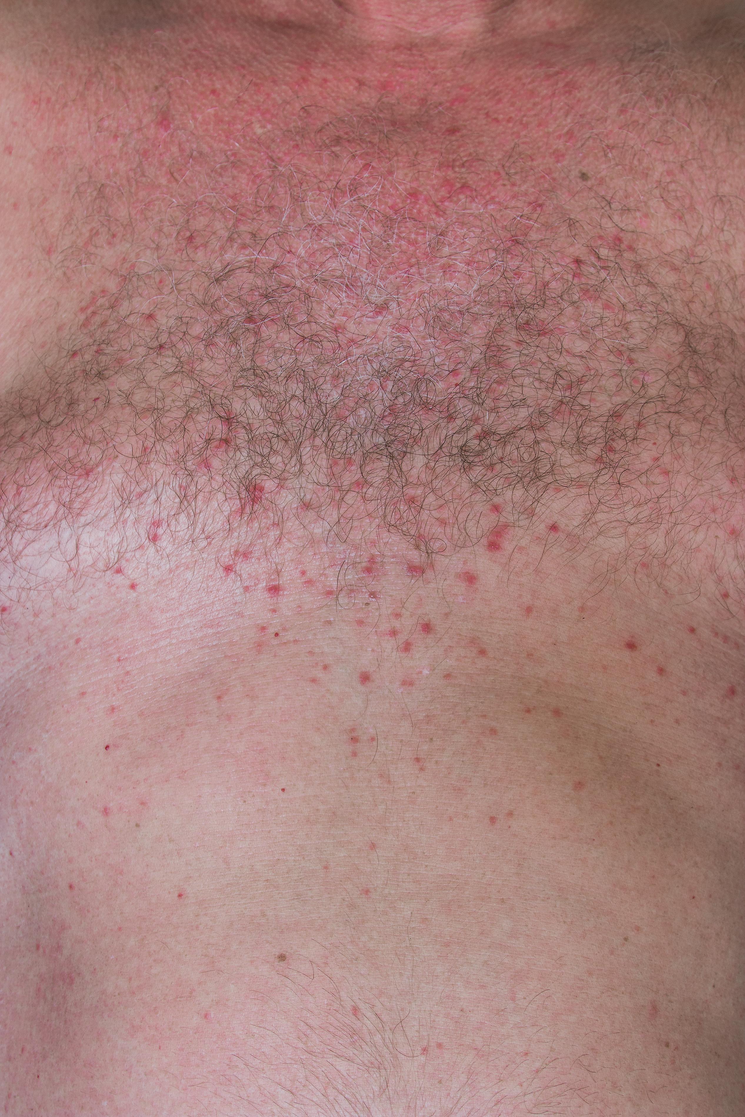 6 common skin rashes that may make your skin itchy, bumpy and red ...